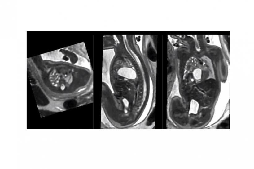 MRI scans more precisely define and detect some abnormalities in unborn ...